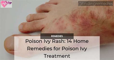 Poison Ivy Rash 14 Home Remedies For Poison Ivy Treatment Natural
