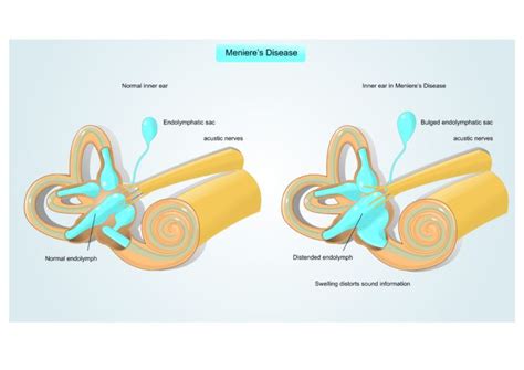 Causes And Treatments Of Vertigo Activebeat