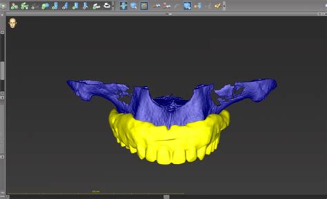 10 Considerations On The Use Of Monolithic Zirconia For One Piece Implant Supported Fixed