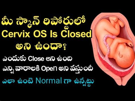 What Is The Meaning Of Cervix Internal Os Closed In Pregnancy Scanning