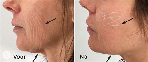 Radiesse Natural Facelift Sarasin Clinic