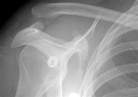 Ac Joint Injuries Hip Knee Shoulder Surgeon Newcastle Dr Ben Mcgrath