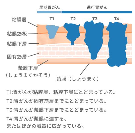 胃がんの症状と原因 初期症状と末期症状、げっぷ・おならは無関係？