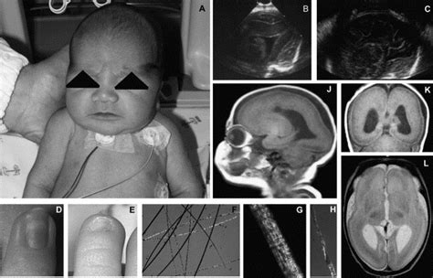 Classical Lissencephaly Associated With Dolichocephaly Hair And Nail