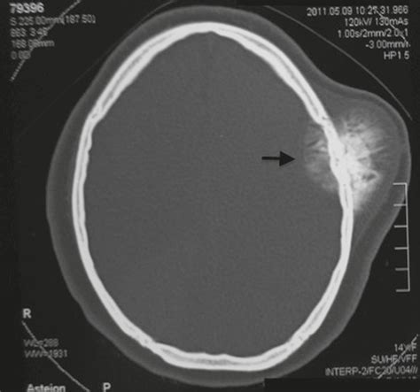 Scielo Brasil Primary Osteosarcoma Of The Cranial Vault Primary