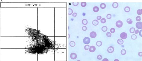 Figure 1 From What Is Your Diagnosis Cytogram Triple Threat