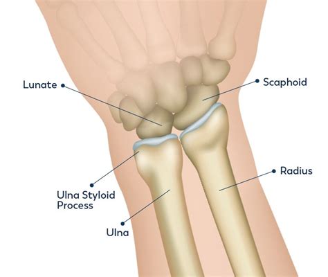 Radial Styloid Process Fracture