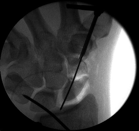 Open Reduction And Internal Fixation Of Scaphoid Fractures Musculoskeletal Key