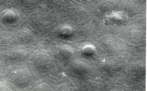 Fleck Corneal Dystrophy