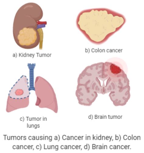 What Are Carcinogens Give Two Examples Why Is The Disease Caused By