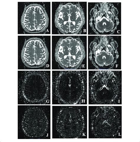 Intravoxel Incoherent Motion Mri Imaging Obtained After Download Scientific Diagram