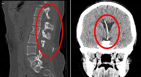 Baclofen Pump Catheter Implanted In Brain Because Tissue Couldnt