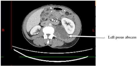 Multiple Liver Splenic And Psoas Abscesses Due To Melioidosis A Case