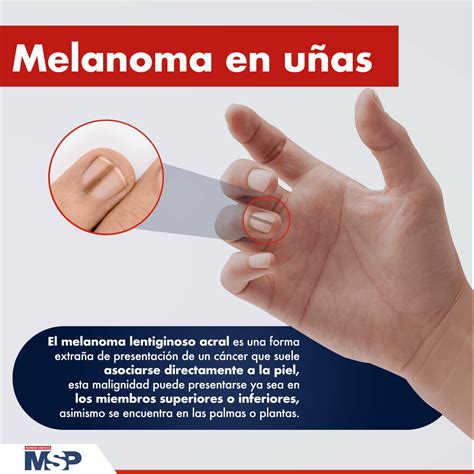 Melanoma En Uñas