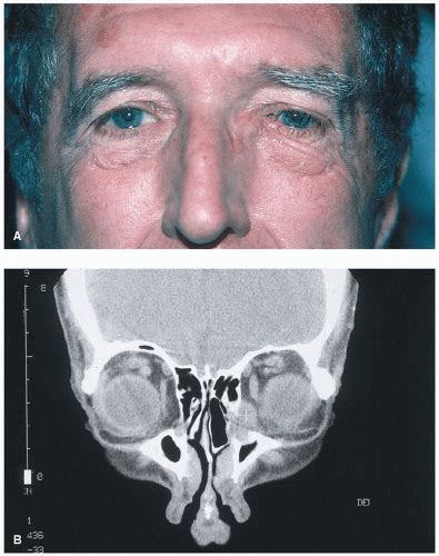 Supraciliary Microstent Surgery Ento Key