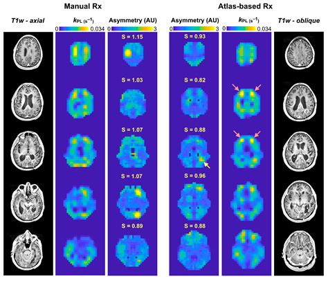 Cancers Free Full Text Advanced Hyperpolarized 13c Metabolic Imaging Protocol For Patients