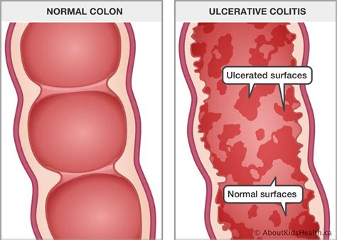 Colon Ulcerative Colitis Understanding Ulcerative Colitis Almurshidi