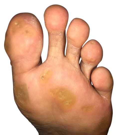 Corns Dubai Podiatry Centre
