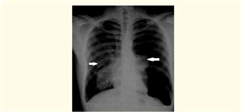 Postero Lateral View Of Chest X Ray Bilateral Primary Spontaneous