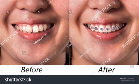 Orthodontic Braces Before And After 1739 Before After Orthodontic