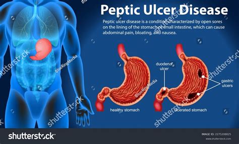 Peptic Ulcer Disease Infographic Illustration Stock Vector Royalty