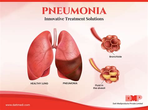 Pneumonia And Innovative Treatment Solutions