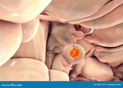 A Pituitary Gland Tumor 3d Illustration Stock Illustration
