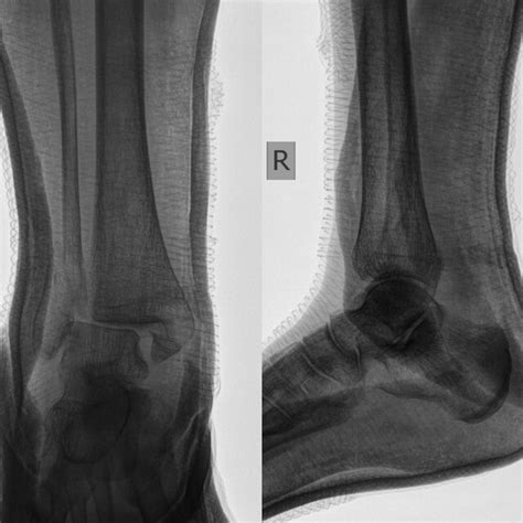 A X Rays Of Bimalleolar Fracture Vohlkmanns Fragment Before