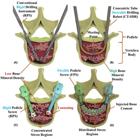 Pedicle Screw Fixation