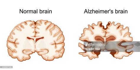 Normal Brain And Alzheimers
