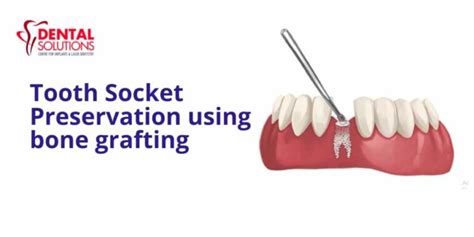 Tooth Socket Preservation Using Bone Grafting 1 Best Dental Clinic In