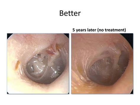 Ppt Tympanic Membrane Retraction And Atelectasis Powerpoint