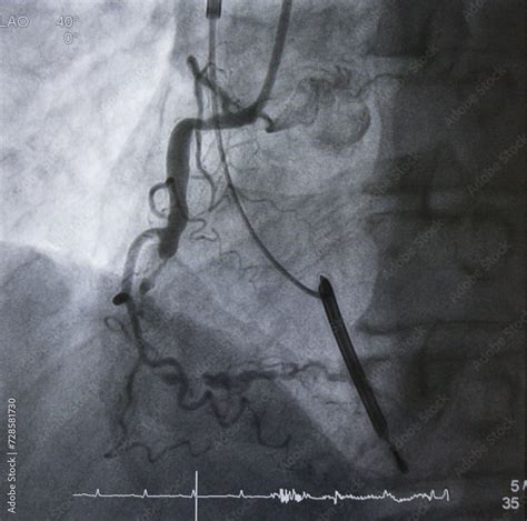 Coronary Angiogram Cag Was Performed Chronic Total Occlusion Cto At