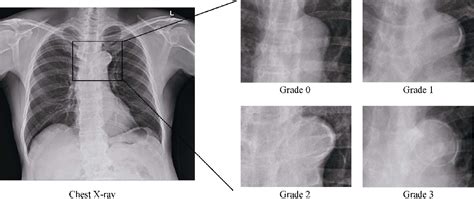 Figure 1 From Aortic Arch Calcification On Chest X Ray Combined With
