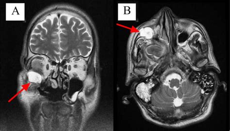 Ameloblastoma Histology Radiology Surgery And Treatment