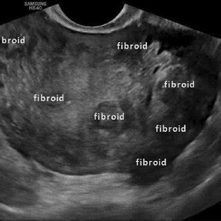 Pdf Reporting Of Uterine Fibroids On Ultrasound Examinations An