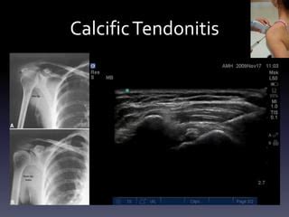 Ultrasound Guided Injections Upper Extremity Pdf