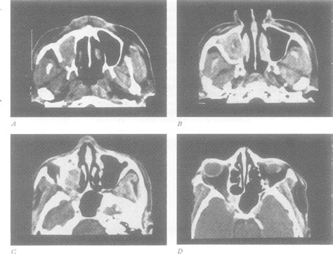 Pdf Lesson Of The Month Neuro Ophthalmological Presentation Of Non