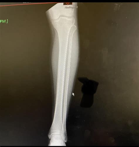 Not Sure How Rare But I Got An All In One Tib Fib R Radiology