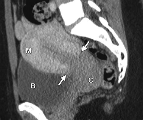 Normal Or Abnormal Demystifying Uterine And Cervical Contrast