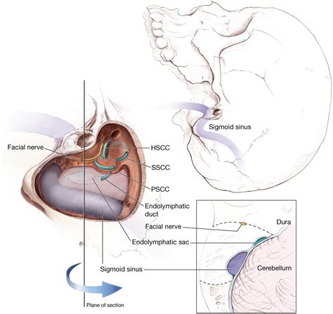 Endolymphatic Sac Decompression