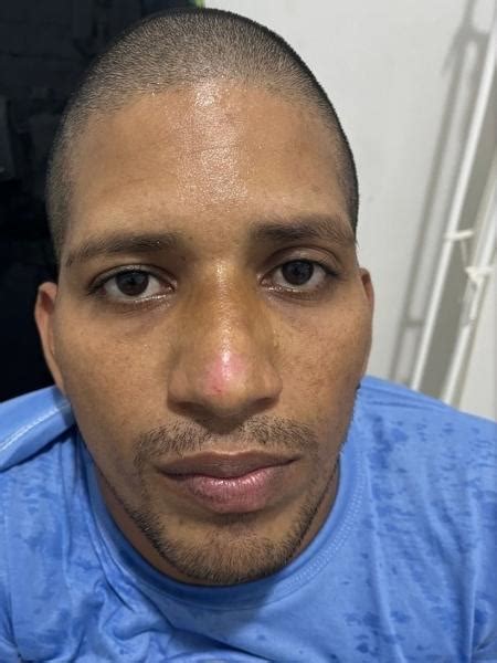 Laudo E Fotos Apontam Que Fugitivo De Mossoró Tinha Lesões Após Prisão