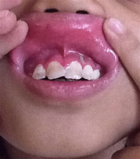 Gingival Hypertrophy In The Patient After Treatment Download Scientific Diagram