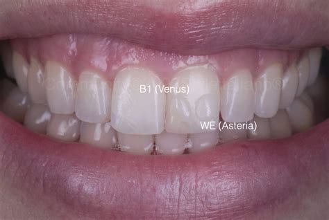 The Emergency Class Iv