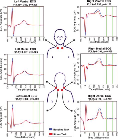 Ecg Amplitude During Baseline And Stress Task Conditions Ecg Was