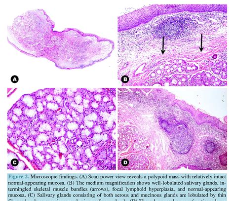 Figure 2 From Hamartomatous Polyp Of Minor Salivary Gland Arising In