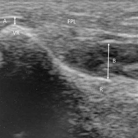 Soong Classification Soong Grade 0 The Plate Is Dorsal To The Volar