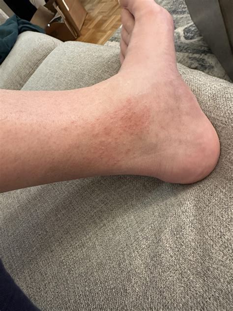 Itchy Raised Rash On Ankle Rdermatologyquestions