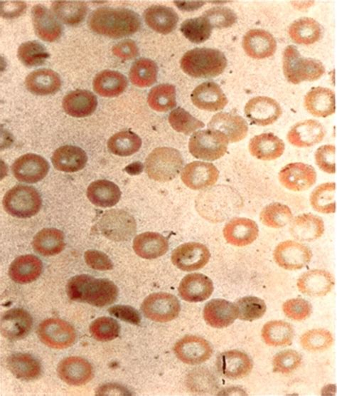 Kleihauerbetke Test • Litfl • Medical Eponym Library