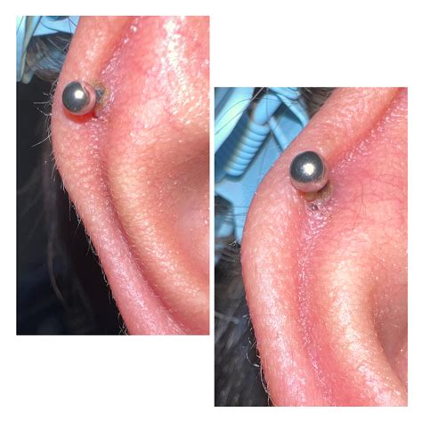Infected Cartilage Piercings Treatment Infected Cartilage Piercing